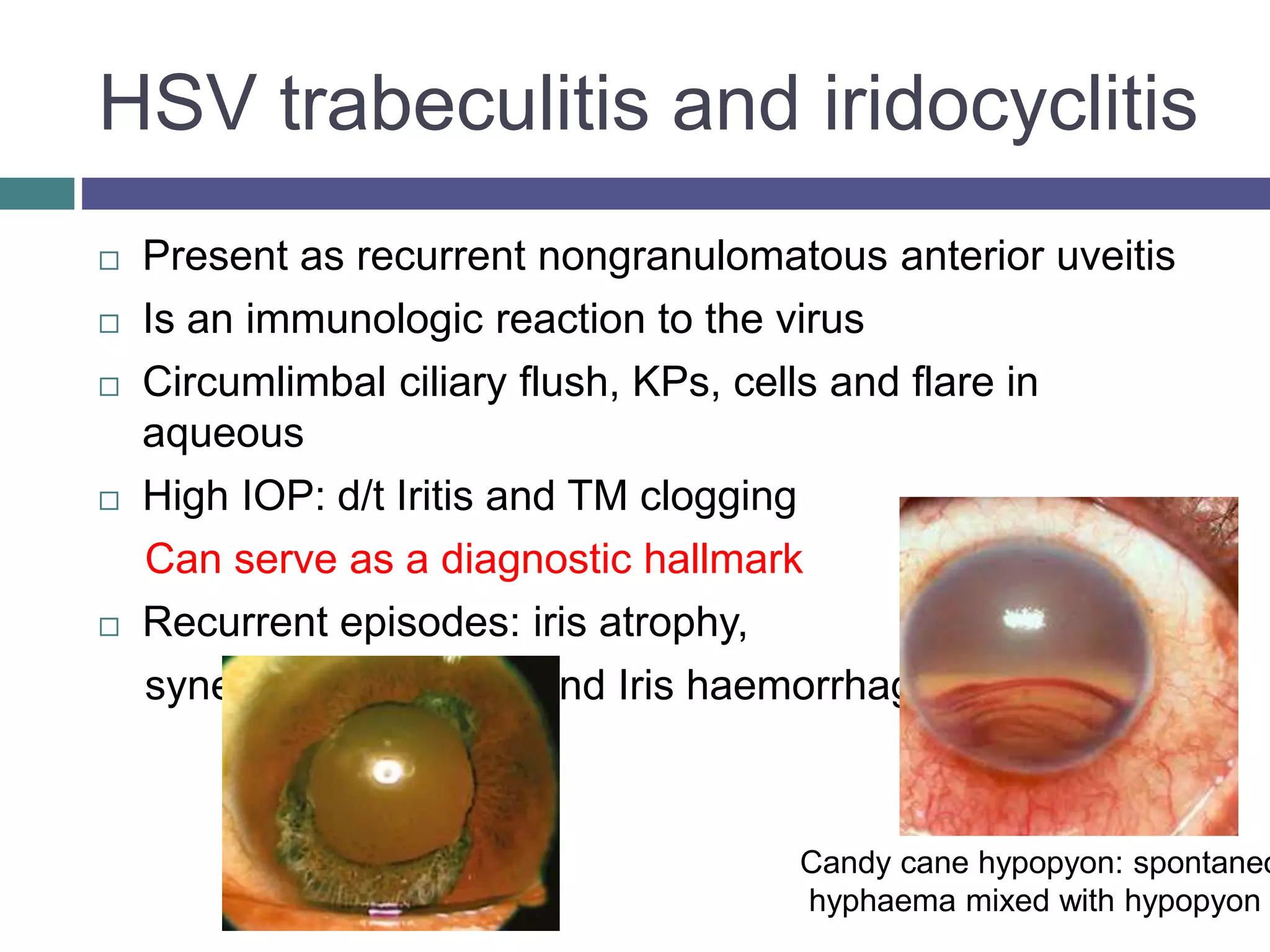 Viral keratitis: Diagnosis and management | PPTX