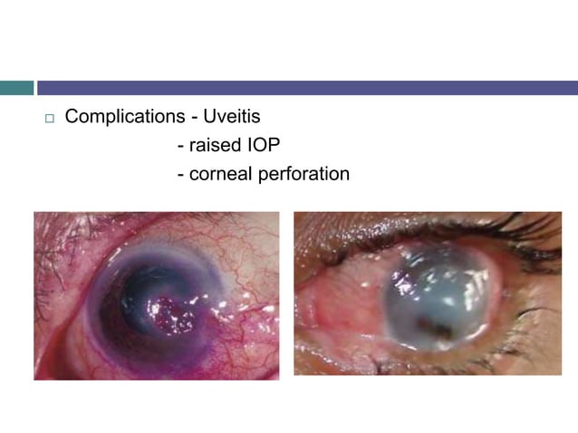 Viral keratitis: Diagnosis and management | PPTX