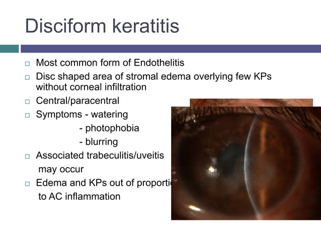 Viral keratitis: Diagnosis and management | PPTX