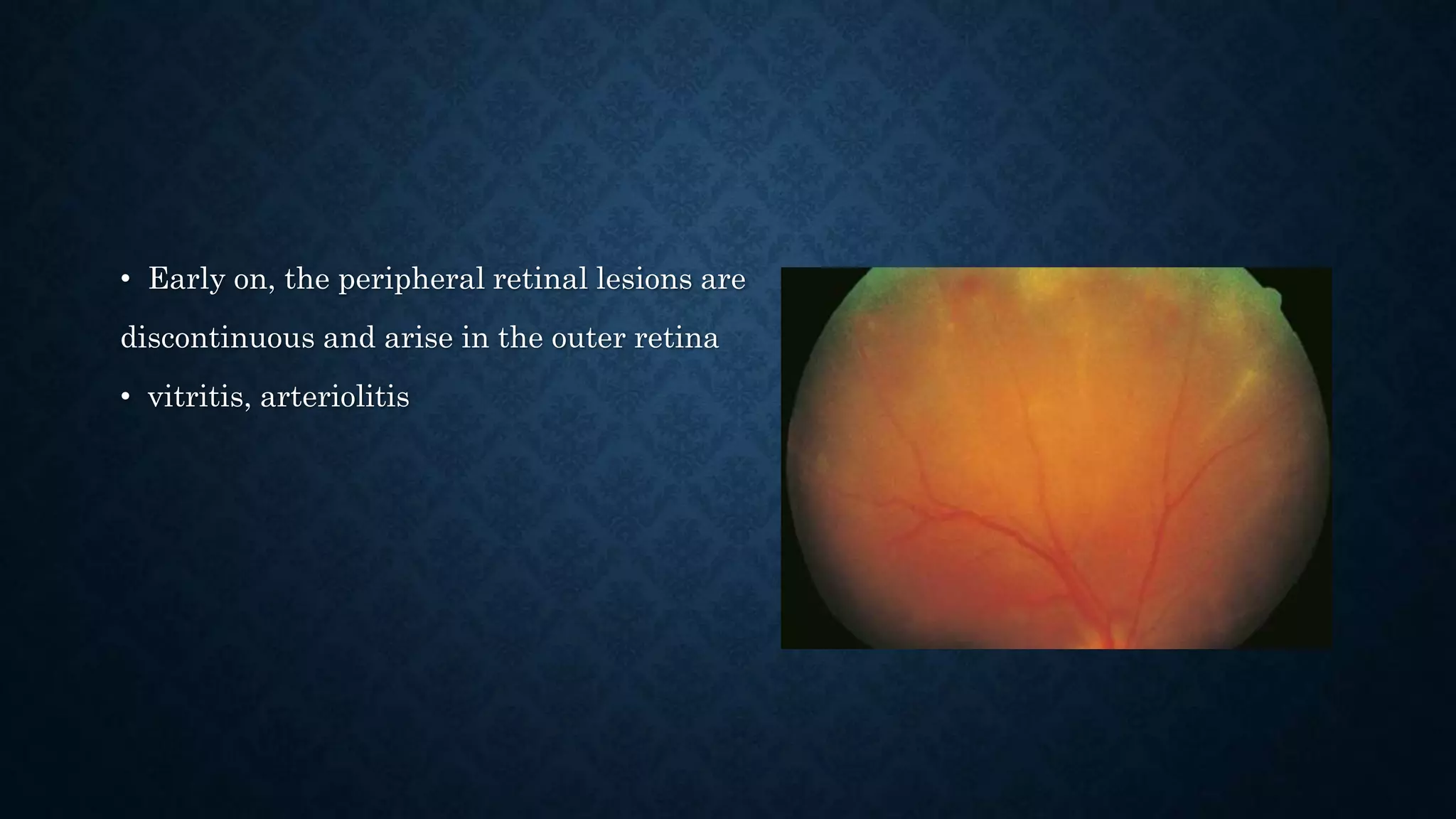 Viral retinitis | PPTX