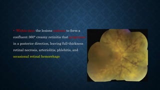 Viral retinitis | PPTX