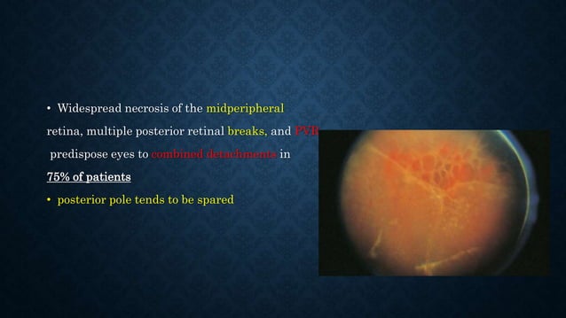 Viral retinitis | PPTX | Infectious Diseases | Diseases and Conditions