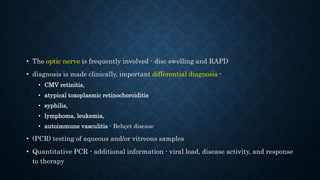 Viral retinitis | PPTX