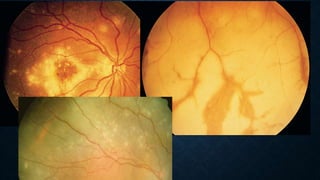 Viral retinitis | PPTX