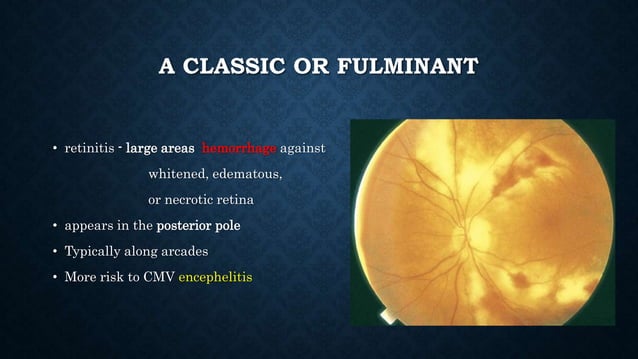 Viral retinitis | PPTX | Infectious Diseases | Diseases and Conditions
