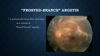 Viral retinitis | PPTX