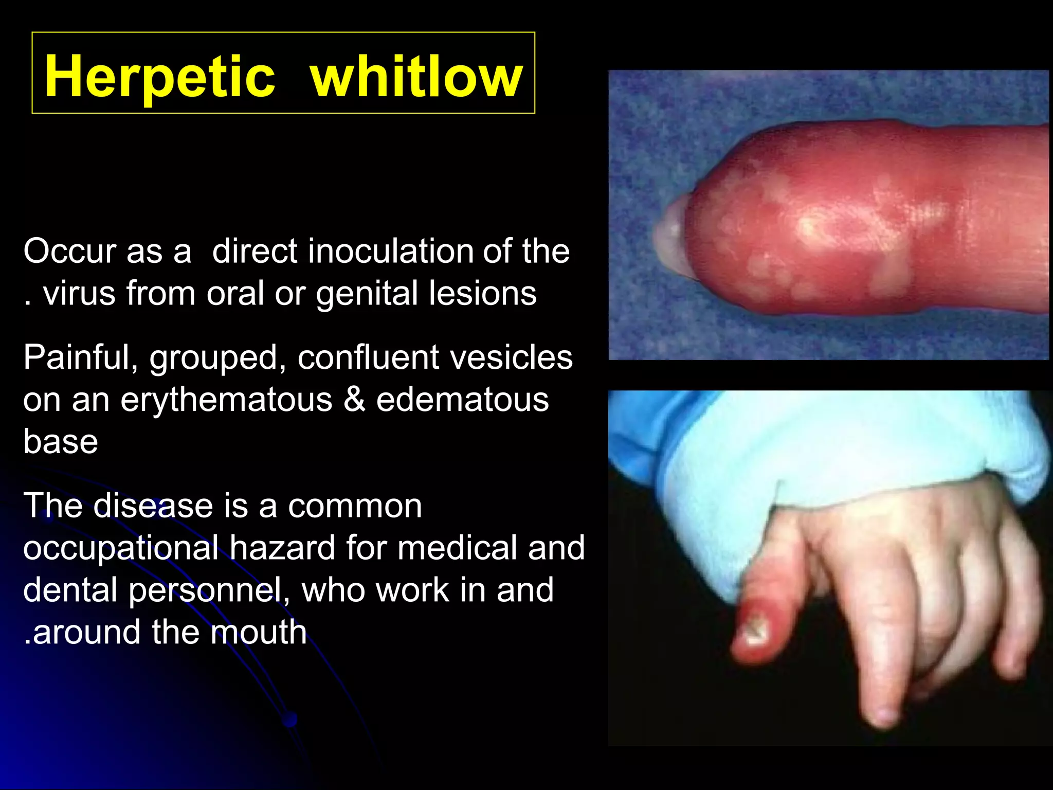 Common Viral Skin Diseases | PPT