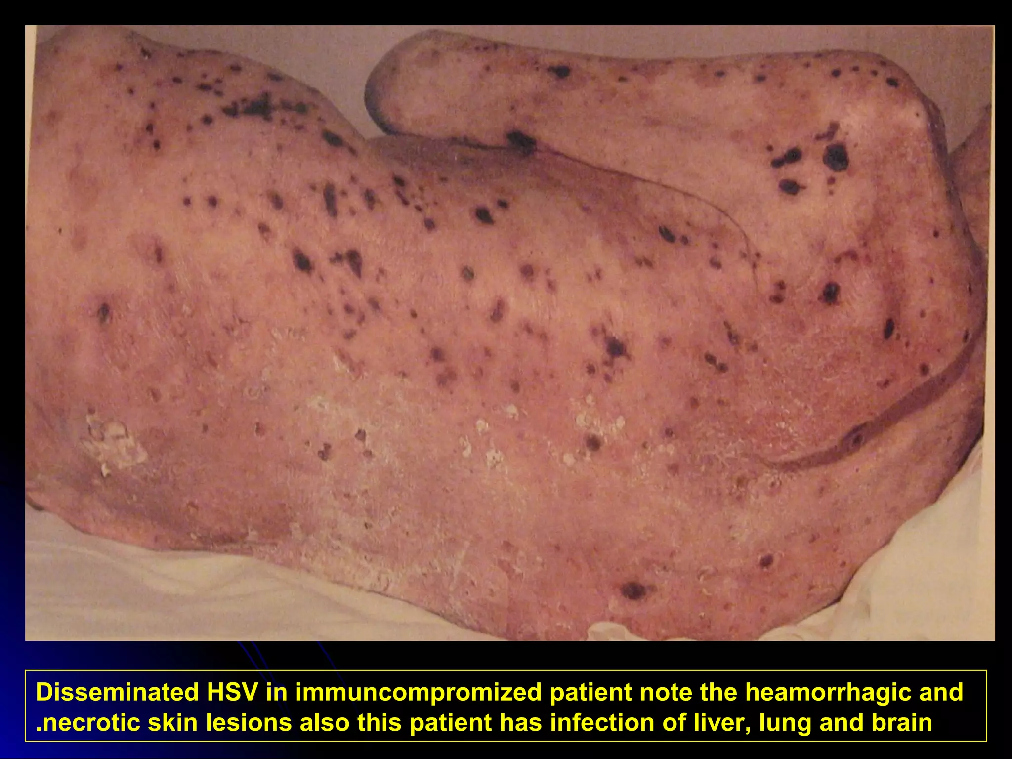 Common Viral Skin Diseases | PPT
