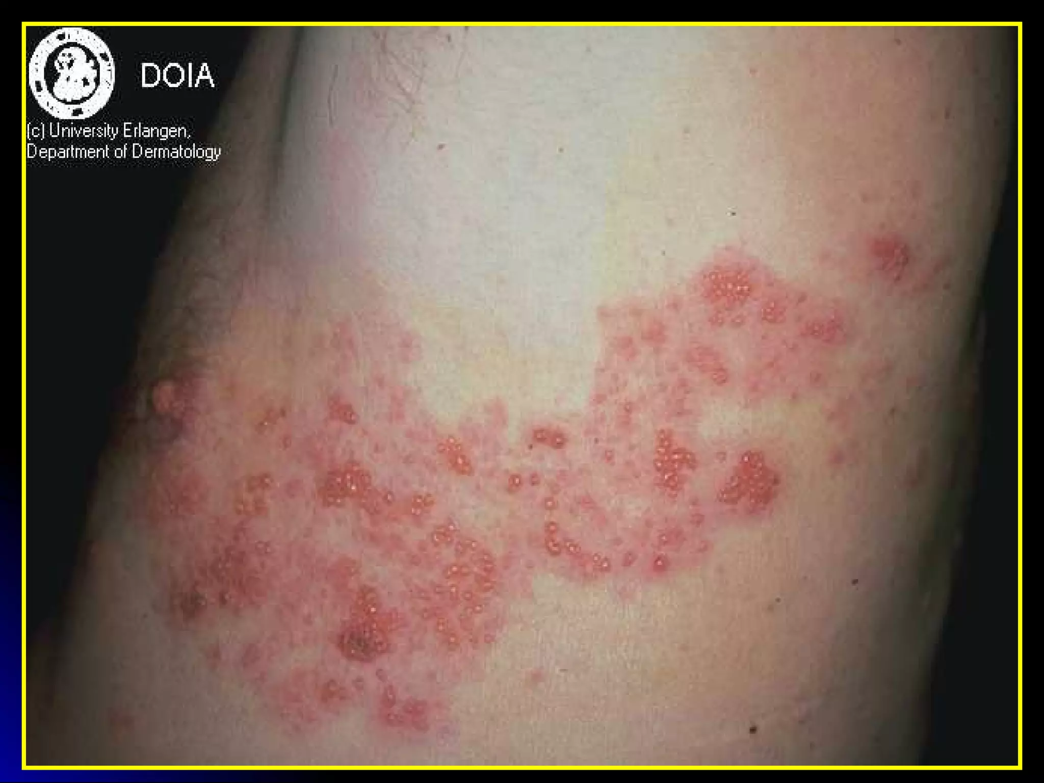 Common Viral Skin Diseases | PPT