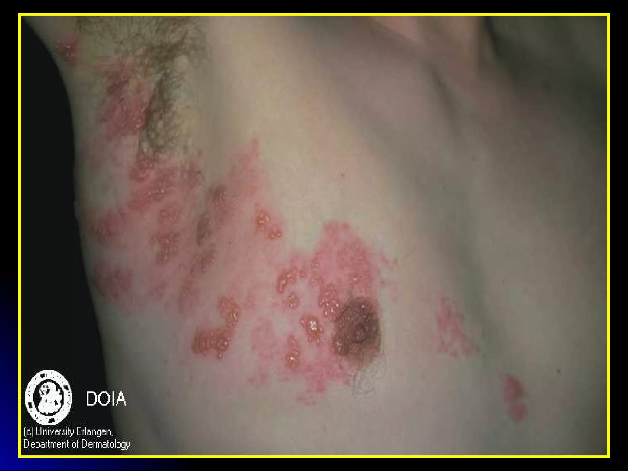 Common Viral Skin Diseases | PPT