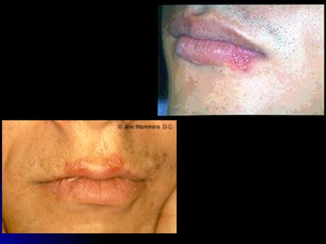 Common Viral Skin Diseases | PPT | Infectious Diseases | Diseases and ...