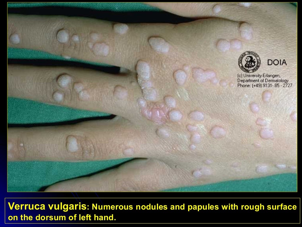 Common Viral Skin Diseases