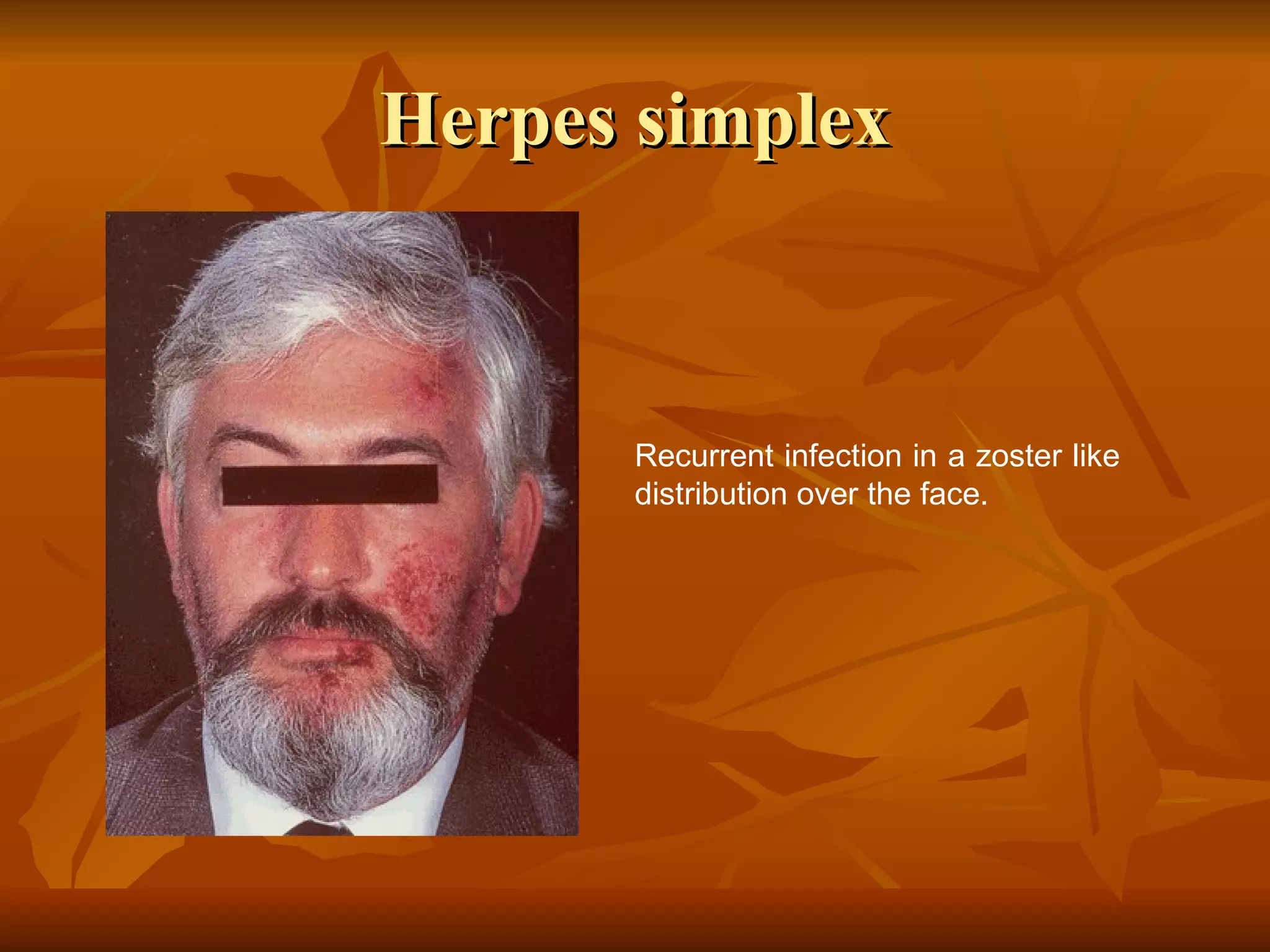 Viral Skin Infection Ppt