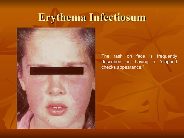 Viral skin infection | PPT