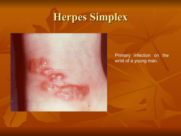 Viral skin infection | PPT