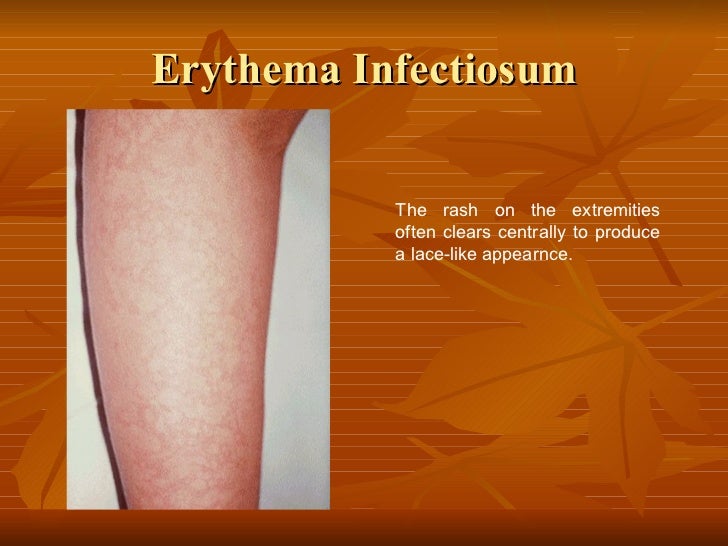 Viral skin infection