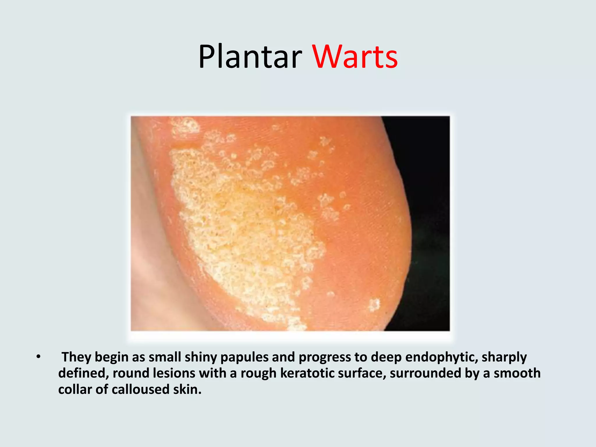 Viral warts | PPTX
