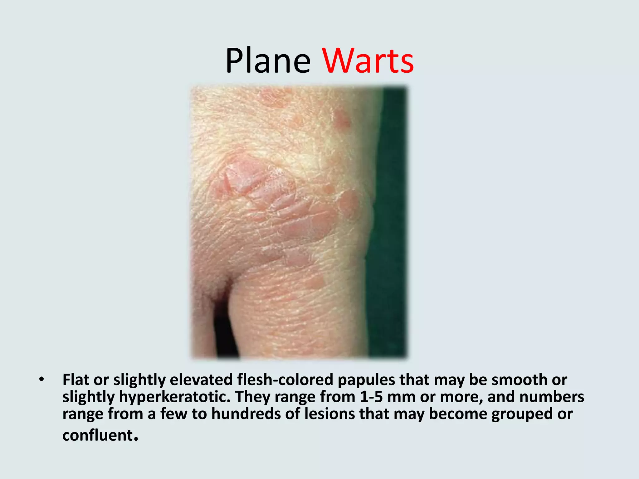 Viral warts | PPTX
