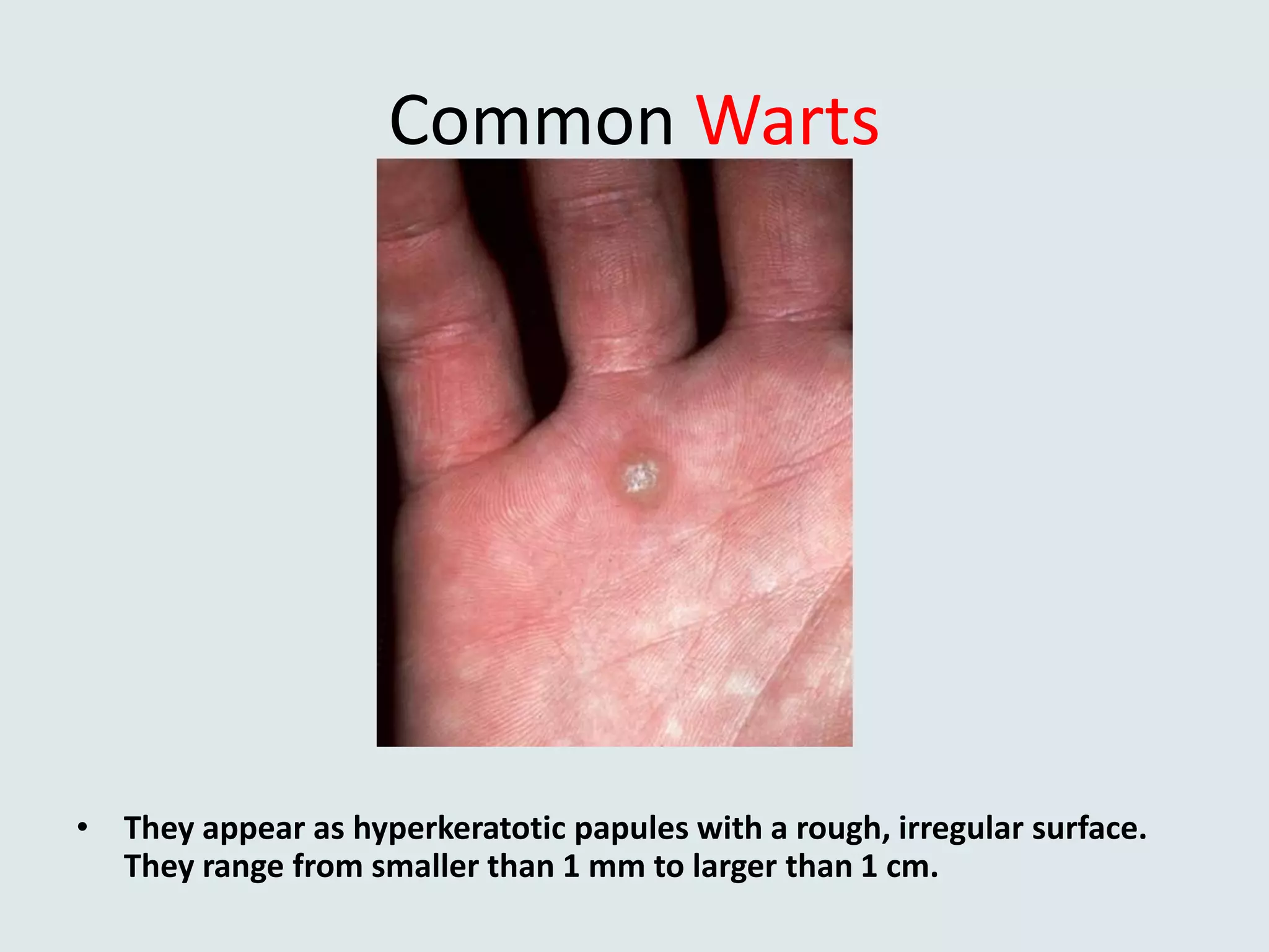 Viral warts | PPTX