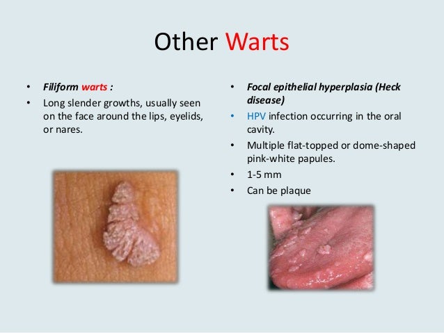 Viral warts