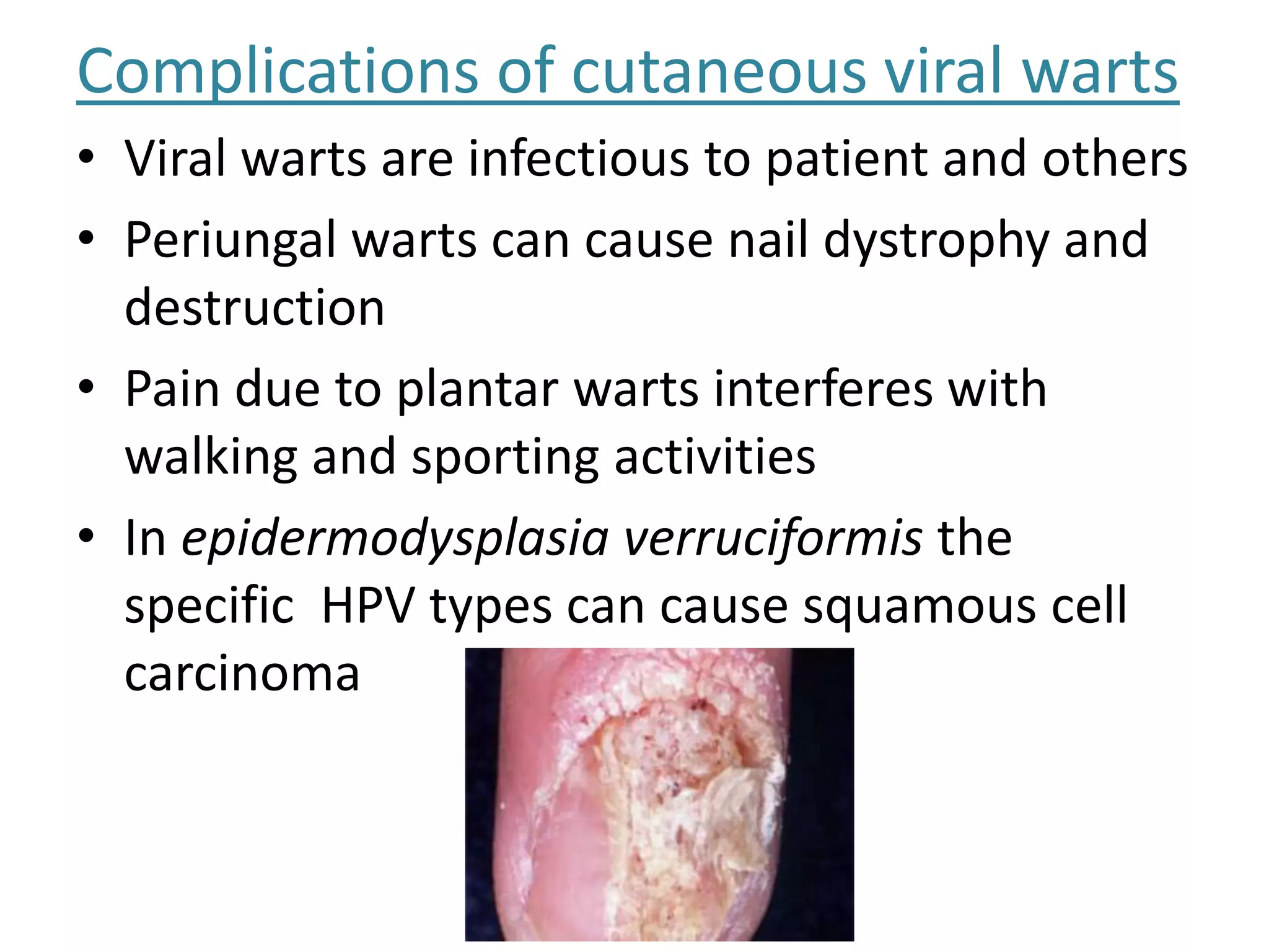 Viral warts | PPT