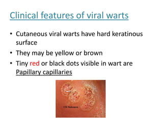 Viral warts | PPT