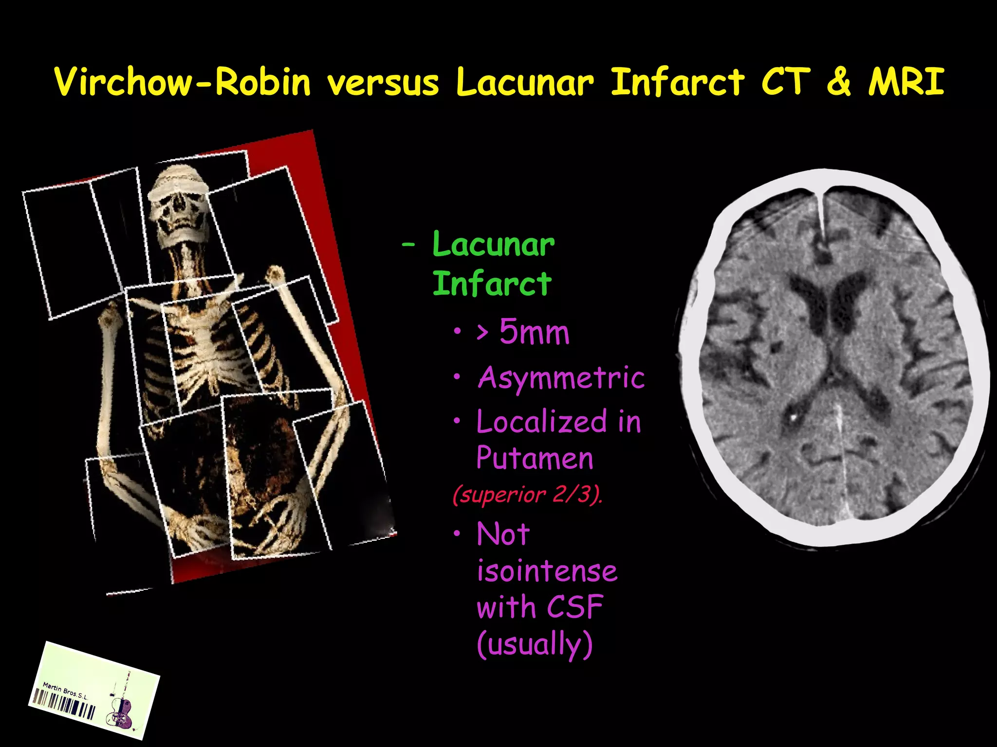 Virchow-Robin versus Lacunar Infarct CT & MRI | PPT
