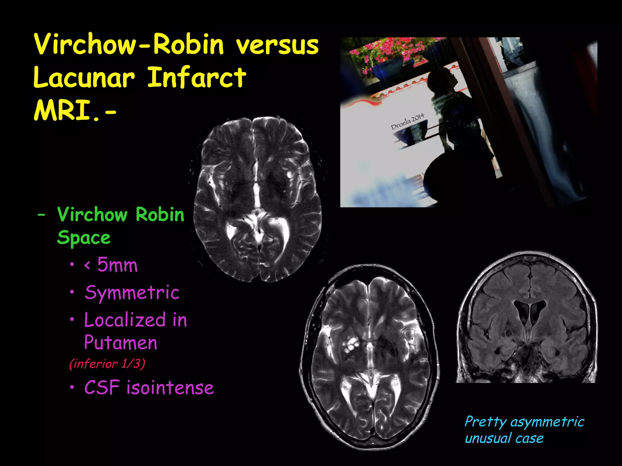 Virchow-Robin versus Lacunar Infarct CT & MRI | PPT