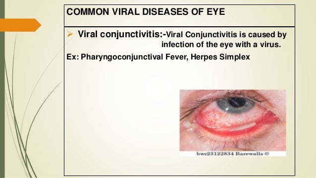Common viral eye diseases & treatment