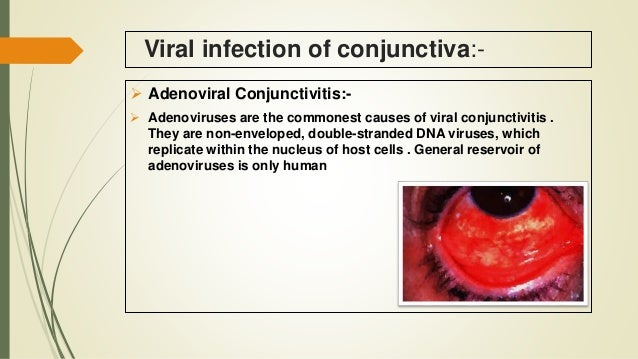 Common viral eye diseases & treatment