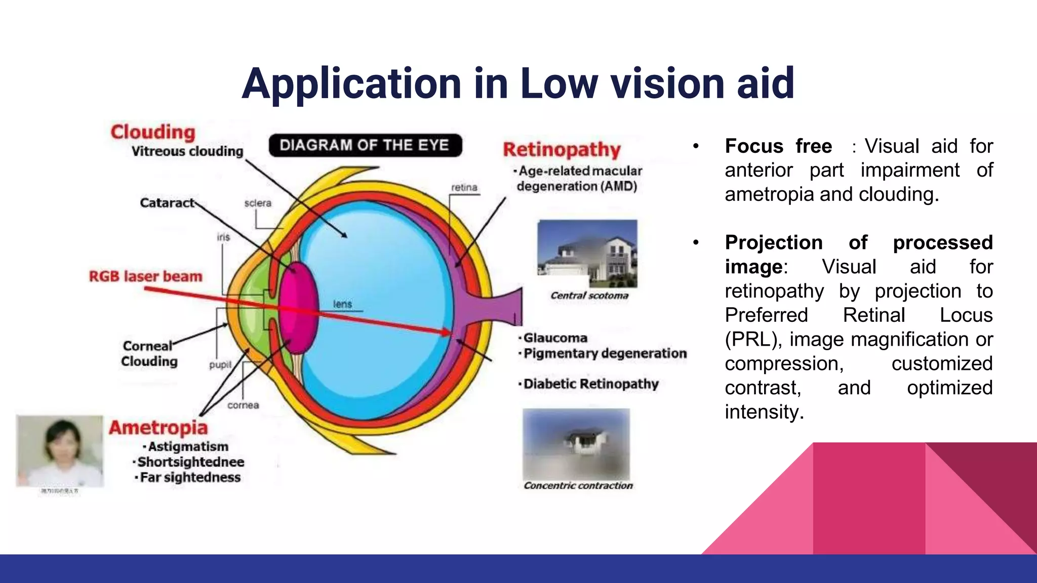 Virtual retinal display - A NEW SIGHT | PPTX