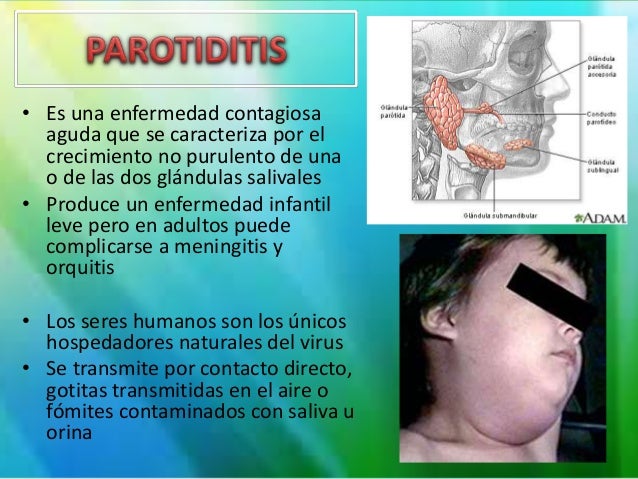 Virus de la parotiditis