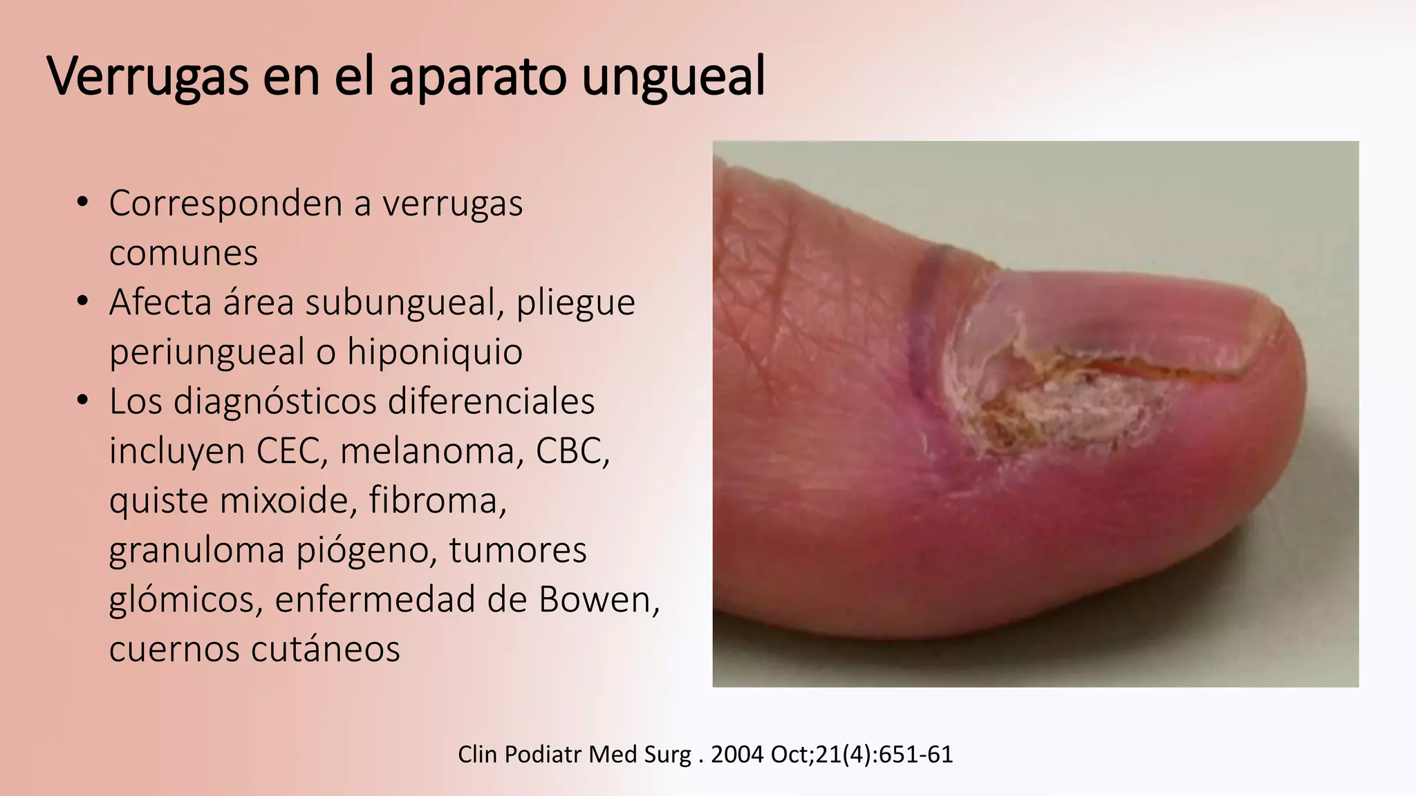 Infección por el Virus del Papiloma Humano (VPH): Verrugas Cutáneas y ...