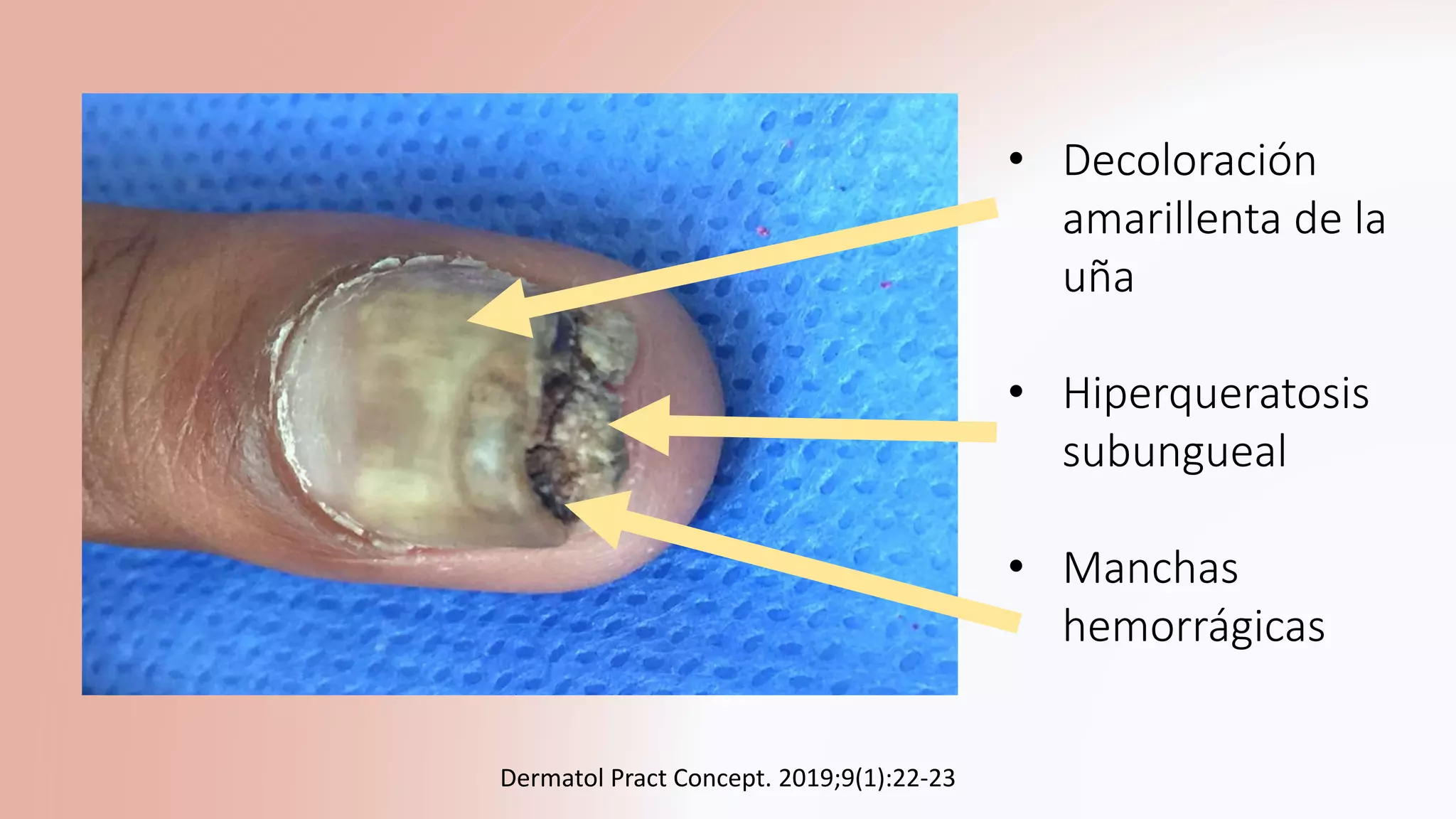 Infección por el Virus del Papiloma Humano (VPH): Verrugas Cutáneas y ...