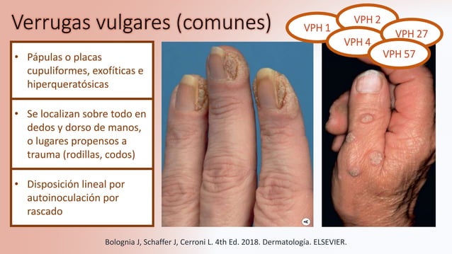 Infección por el Virus del Papiloma Humano (VPH): Verrugas Cutáneas y ...