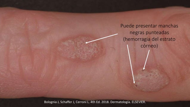 Infección por el Virus del Papiloma Humano (VPH): Verrugas Cutáneas y ...
