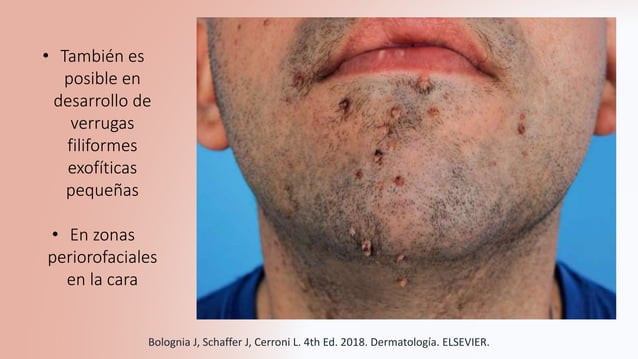 Infección por el Virus del Papiloma Humano (VPH): Verrugas Cutáneas y ...