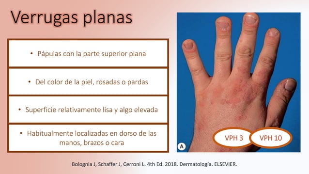 Infección por el Virus del Papiloma Humano (VPH): Verrugas Cutáneas y ...