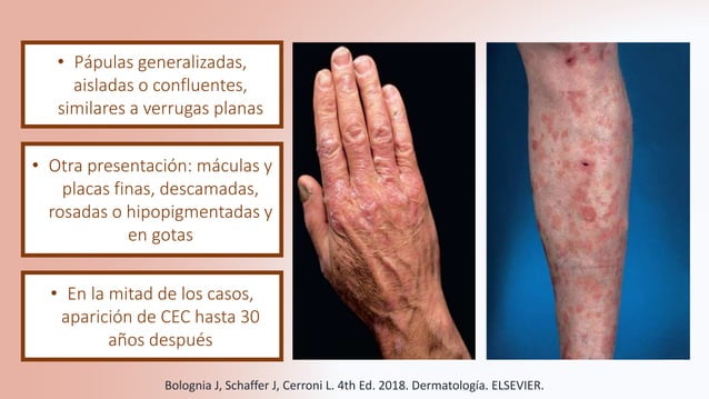 Infección por el Virus del Papiloma Humano (VPH): Verrugas Cutáneas y ...