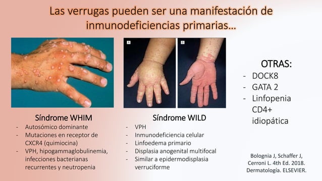 Infección por el Virus del Papiloma Humano (VPH): Verrugas Cutáneas y ...
