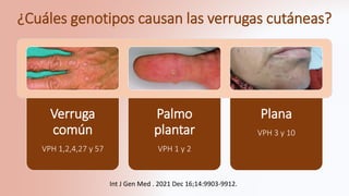 Infección por el Virus del Papiloma Humano (VPH): Verrugas Cutáneas y ...