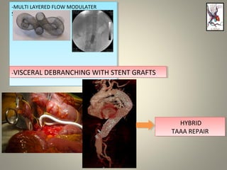 Visceral debranching for the treatment of taaa | PPT