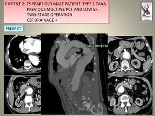 Visceral debranching for the treatment of taaa | PPT