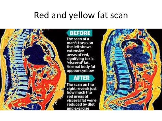 Visceral fat