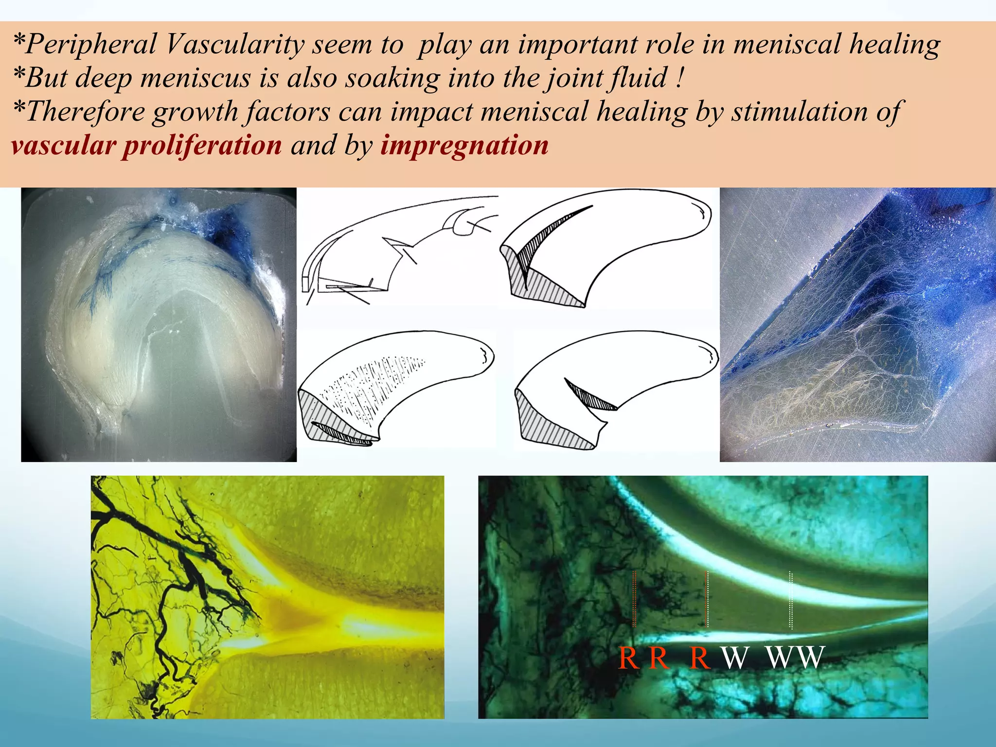 Injections Intra-Articulaires « Single Shot » de Facteurs de Croissance ...