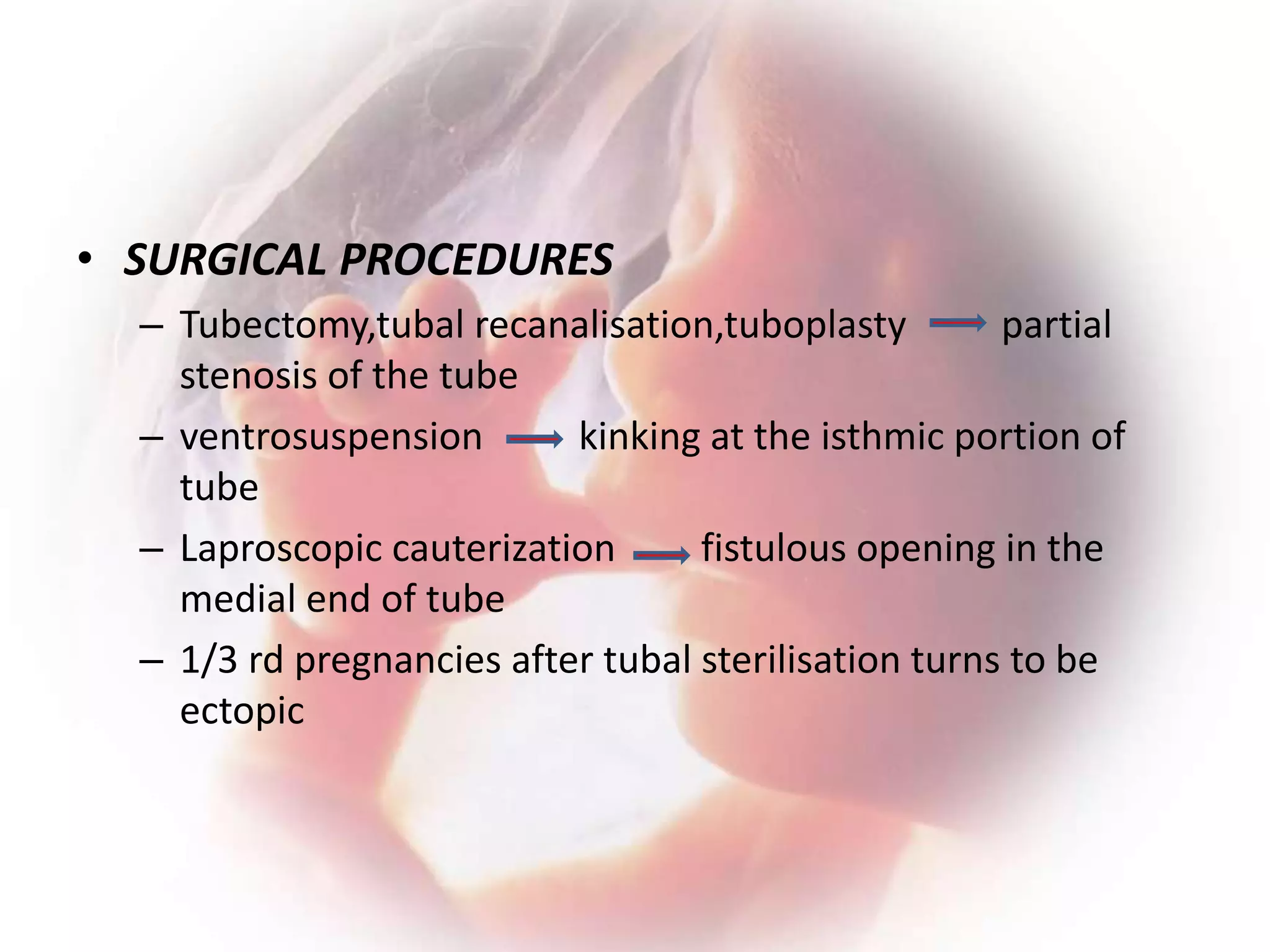 ectopic pregnancy | PPTX