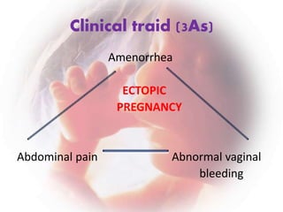 ectopic pregnancy | PPTX
