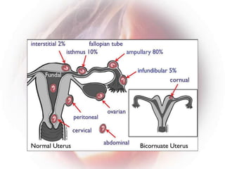 ectopic pregnancy | PPTX