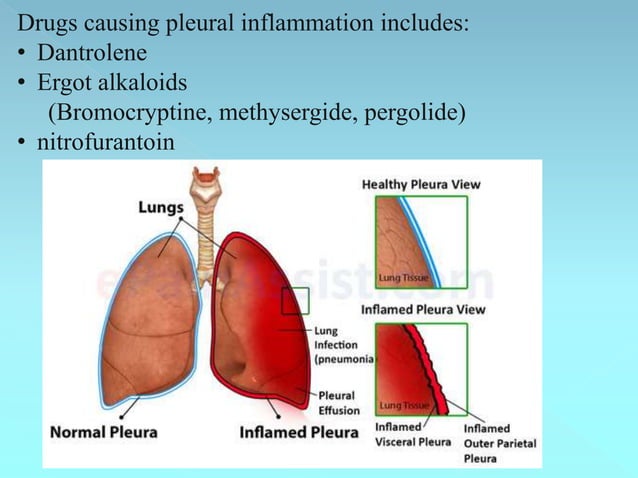 Drug Induced Pulmonary Diseases | PPTX | Lung and Respiratory Health ...