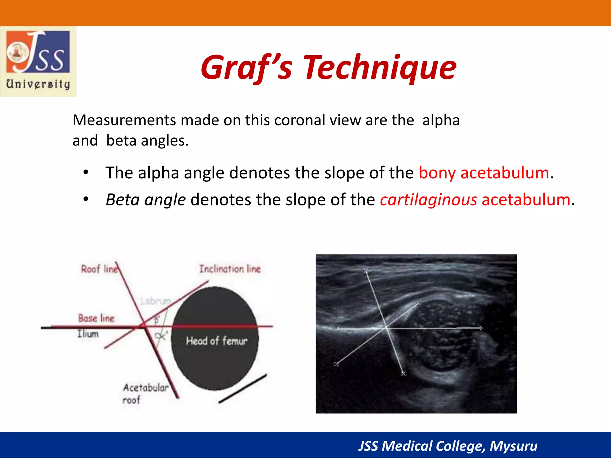 Hip ultrasonography in infants and children | PPTX